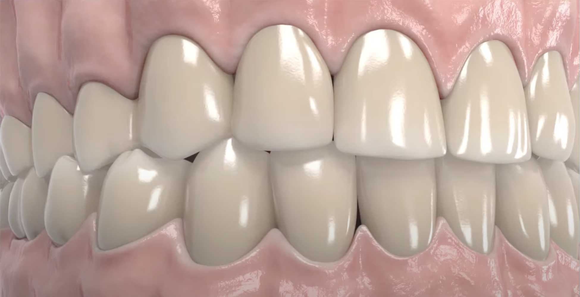 Crema Dental Opalescence Whitening Toothpaste - Ultradent - Casa Dental ...