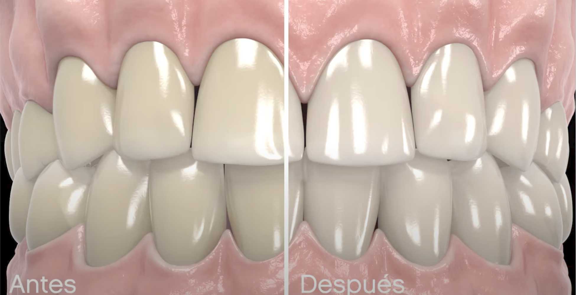 Crema Dental Opalescence Whitening Toothpaste - Ultradent - Casa Dental ...